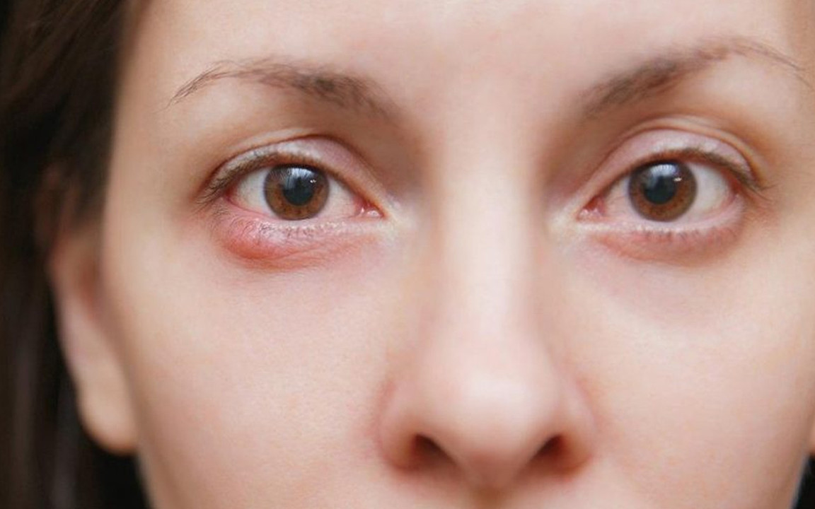 Gözdeki arpacık evde nasıl tedavi edilir? - Sağlık Haberleri